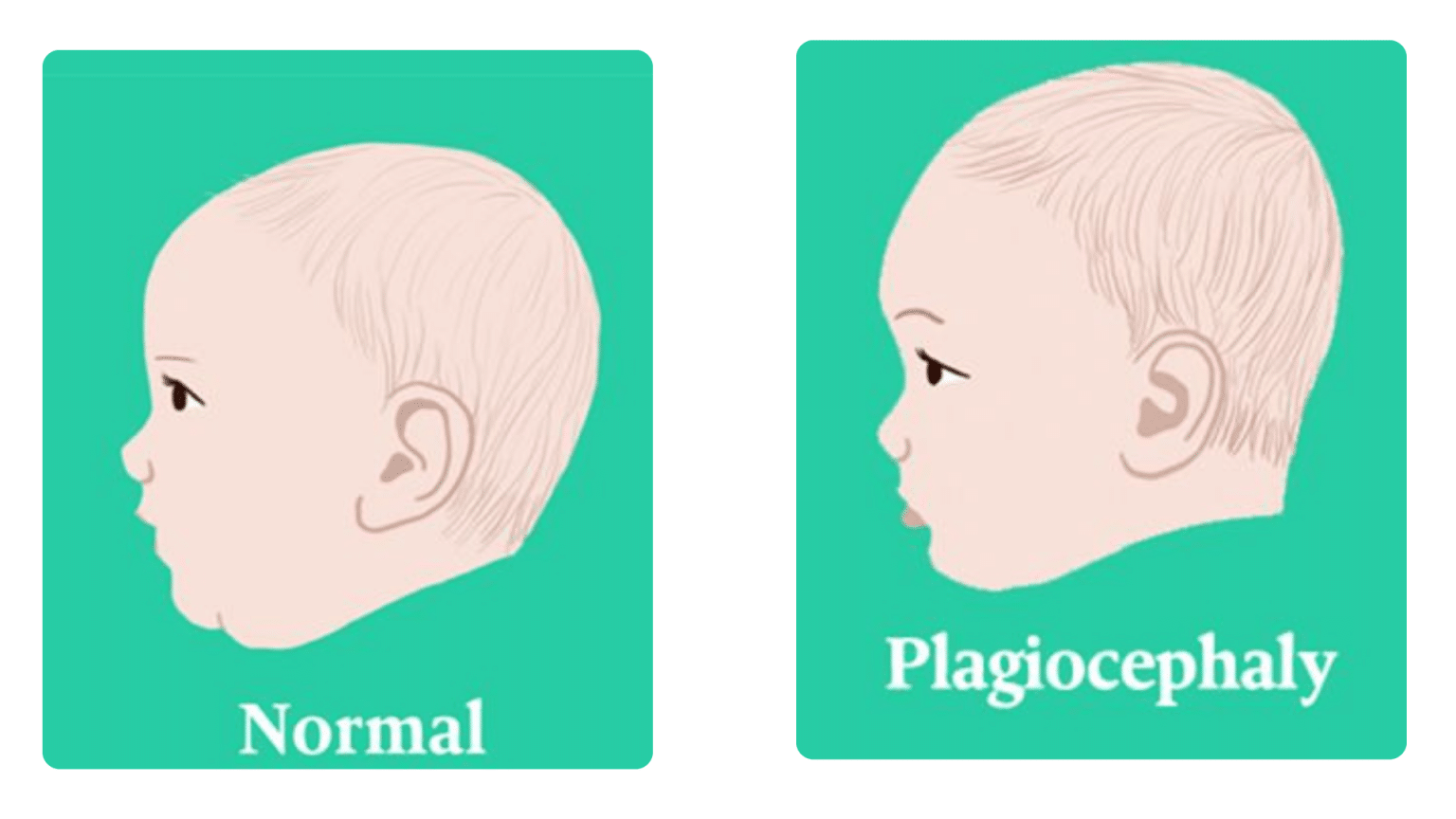 Babies’ Head Shapes: When to Worry and What to Do - Rich Single Momma