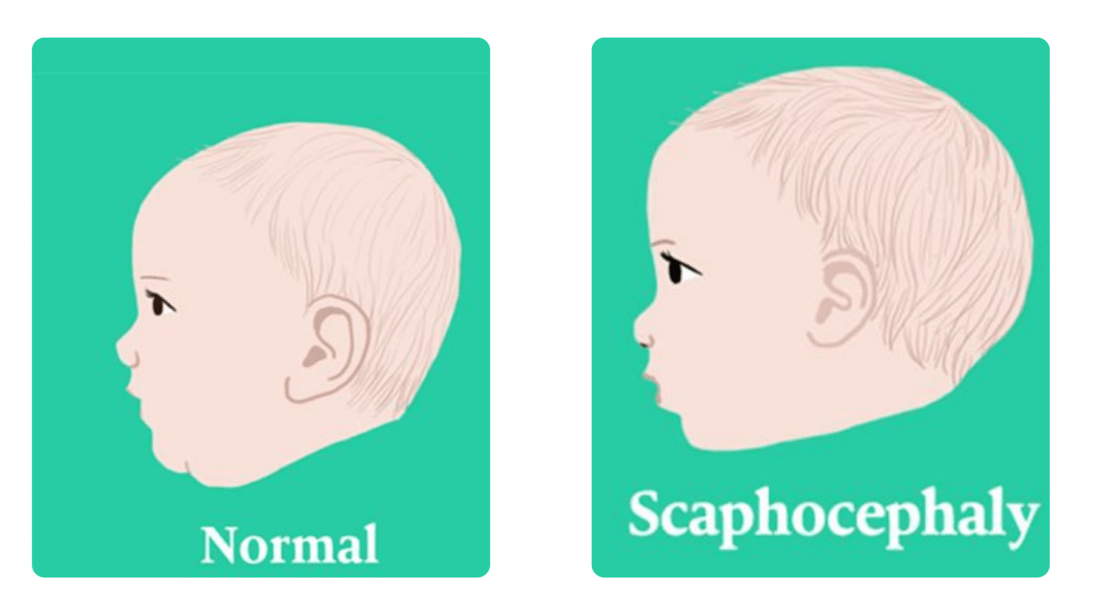 Babies’ Head Shapes: When to Worry and What to Do - Rich Single Momma